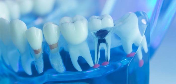 Root Canal Therapy in Tallahassee, Florida - First Care Dental Associates